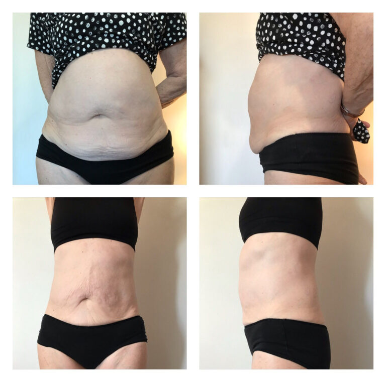 Lucy CRYO Services – Ottawa affordable CRYO treatment & EMS Sculpting Treatment | Located the ...