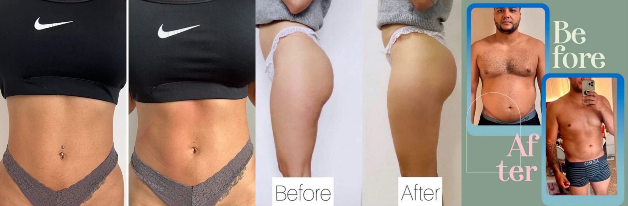 Coolsculpting Ottawa ON - Body Contouring Lucy Cryo Services